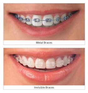 Invisible Braces in Bushwick, Brooklyn | Clear Invisalign Aligners