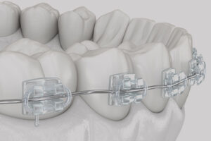 Clear Braces in Bushwick, Brooklyn | Top Orthodontic Treatment
