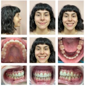 Clear Retainers in Brooklyn, NY | Dental Retainers