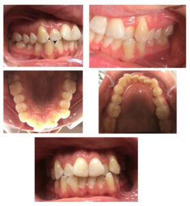 Clear Retainers in Brooklyn, NY | Dental Retainers