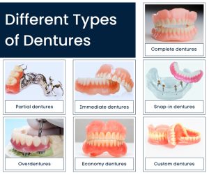 7 Different Types of Dentures: Which One Is Best For You? | Broadway ...