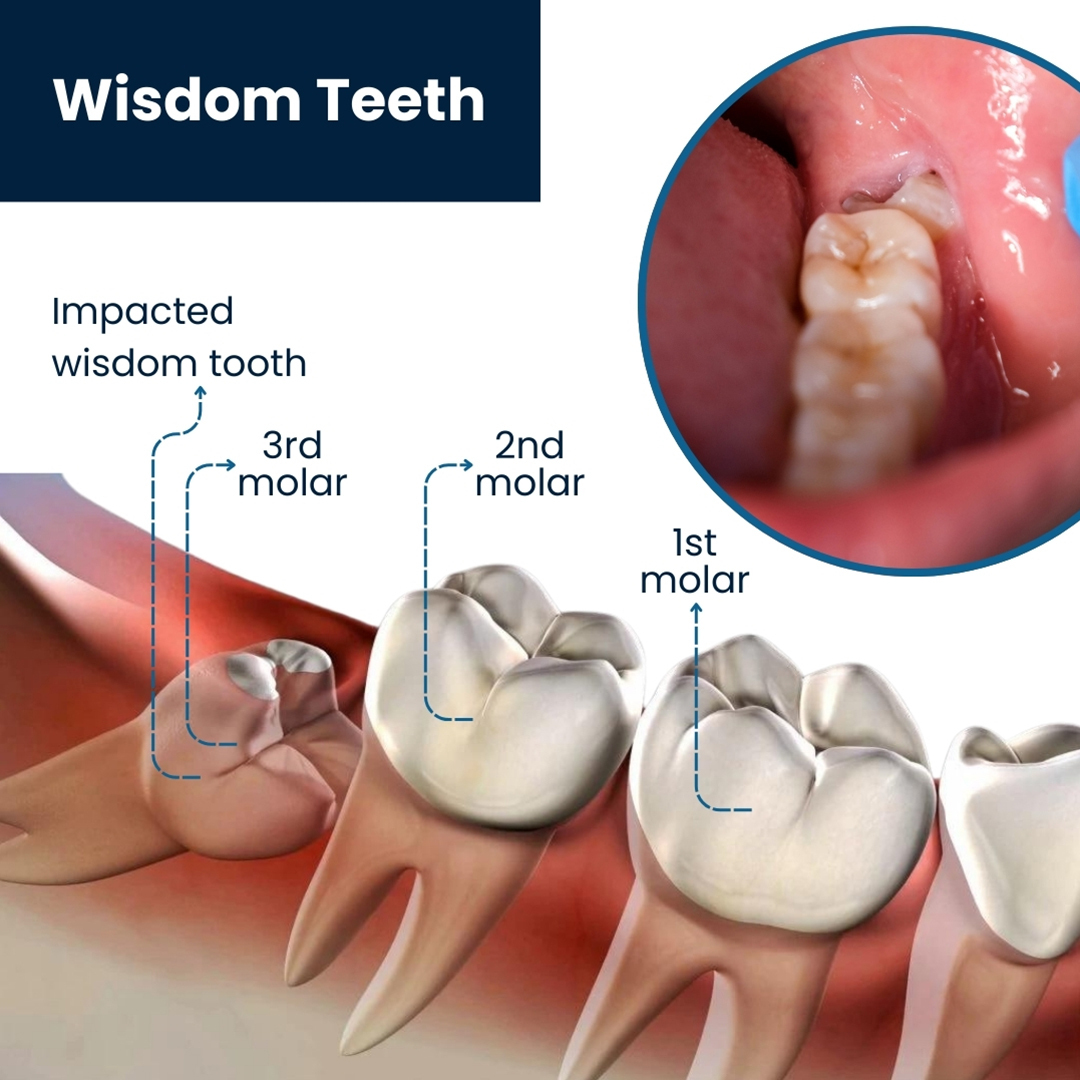 Tooth Extraction Good Healing